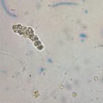 White Blood Cell Casts: Identification & Significance - MedLabBuddy