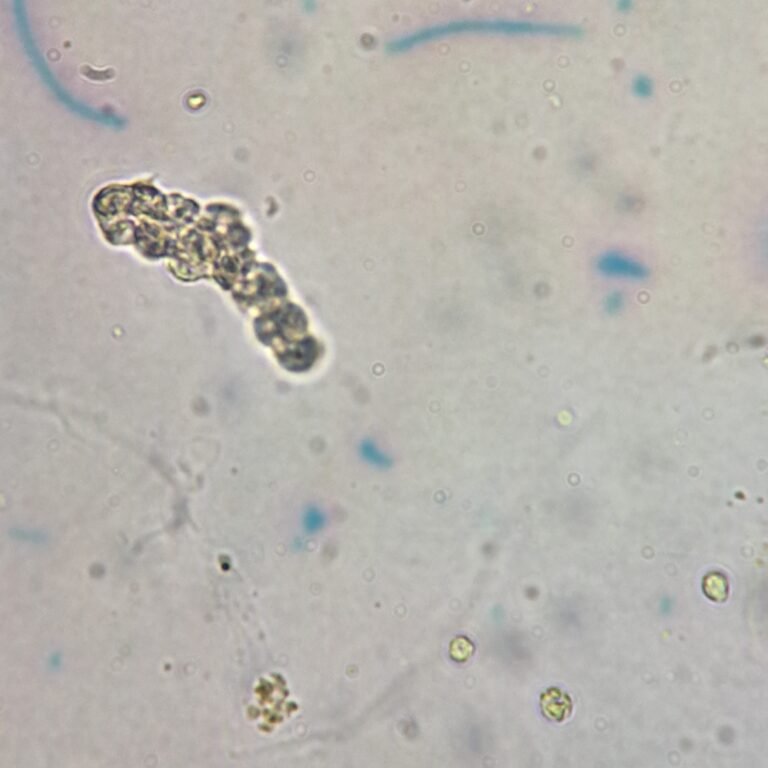 White Blood Cell Casts: Identification & Significance - MedLabBuddy