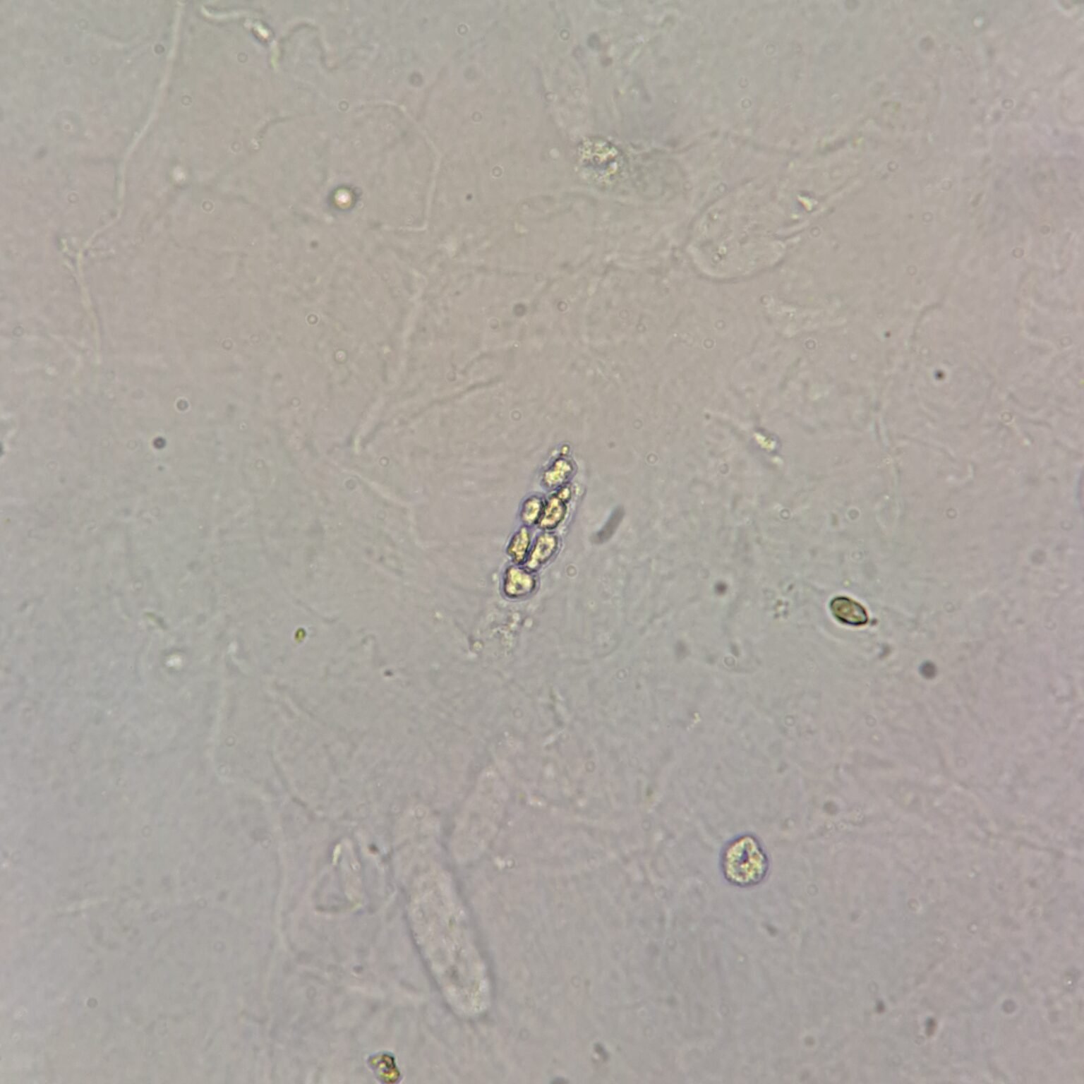 White Blood Cell Casts: Identification & Significance - MedLabBuddy
