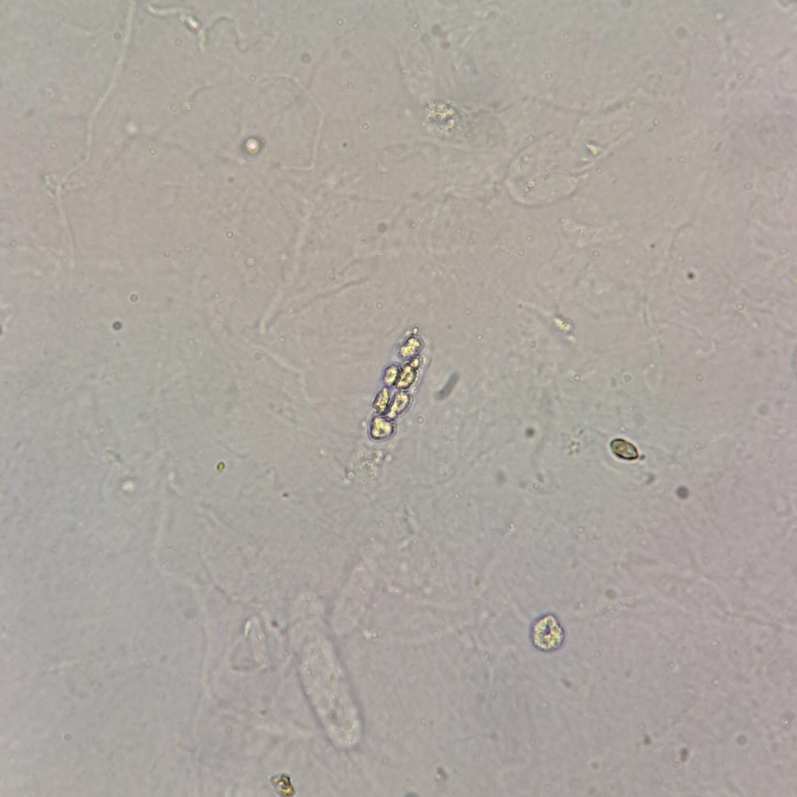 White Blood Cell Casts: Identification & Significance - MedLabBuddy