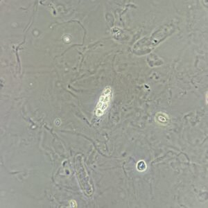 White Blood Cell Casts: Identification & Significance - MedLabBuddy