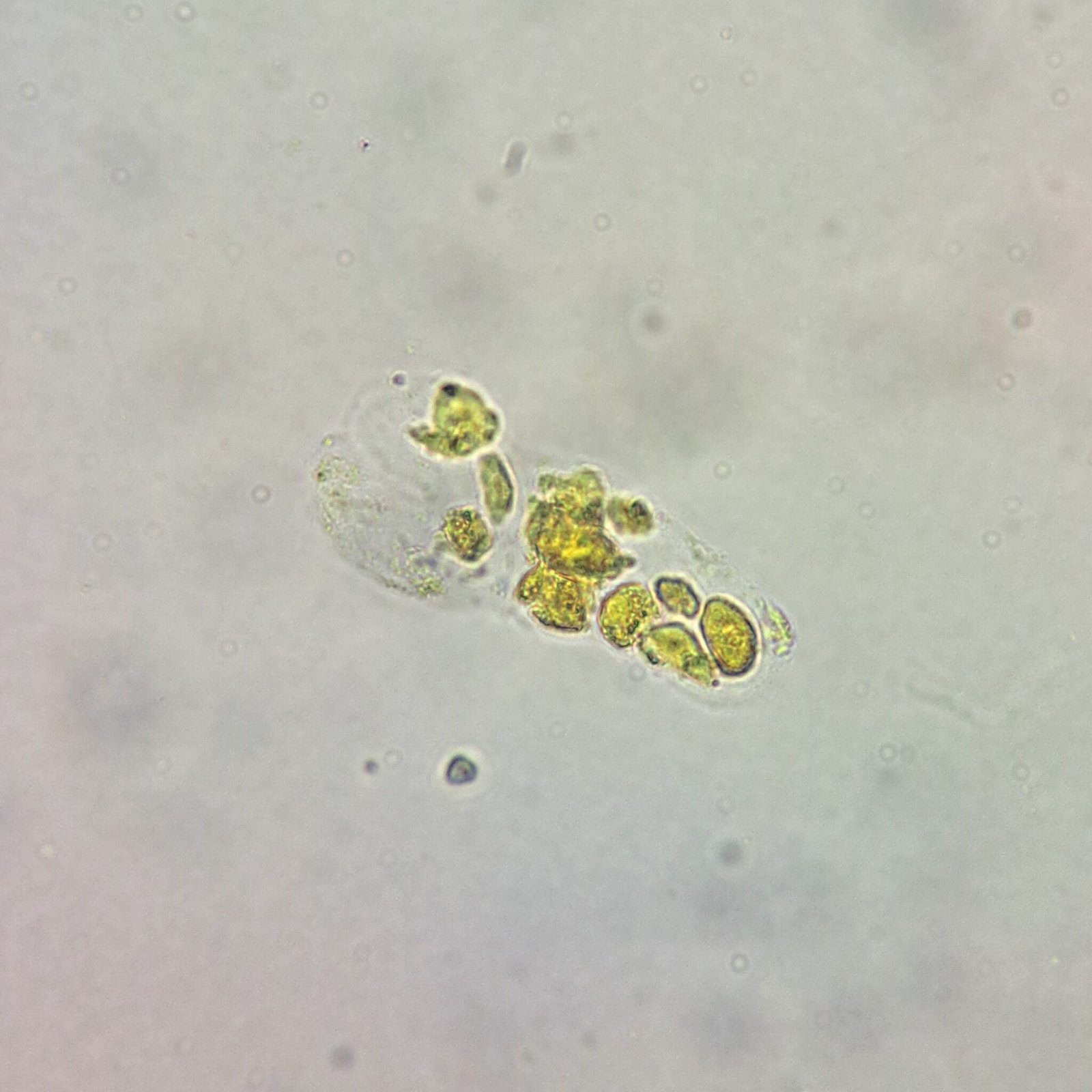 White Blood Cell Casts: Identification & Significance - MedLabBuddy