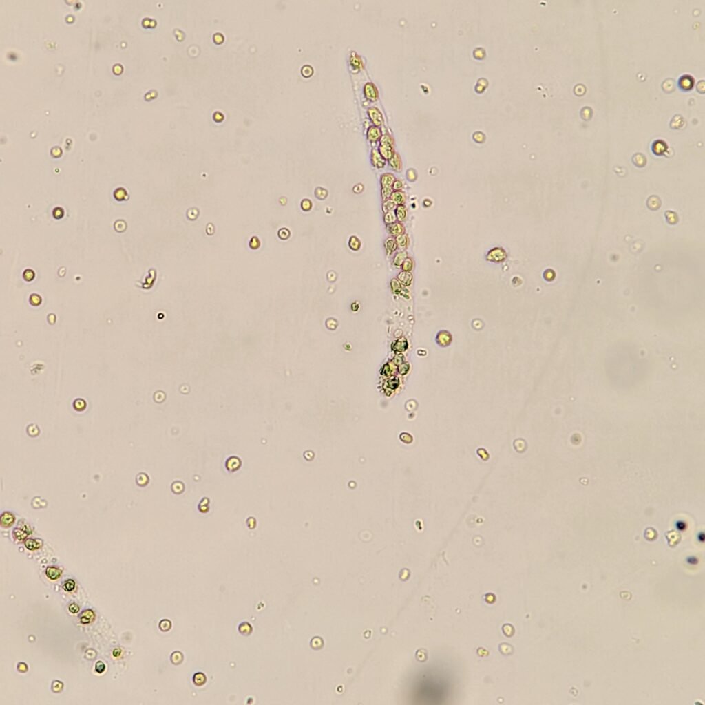 White Blood Cell Casts: Identification & Significance - MedLabBuddy