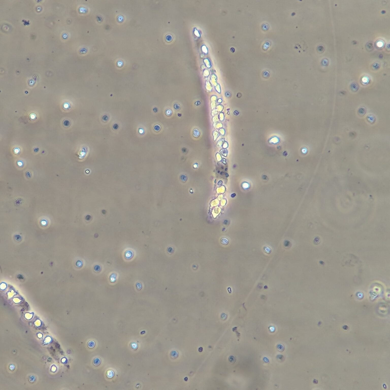White Blood Cell Casts: Identification & Significance - MedLabBuddy