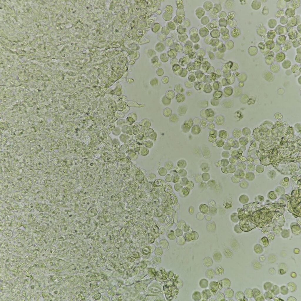 White Blood Cell Casts: Identification & Significance - MedLabBuddy