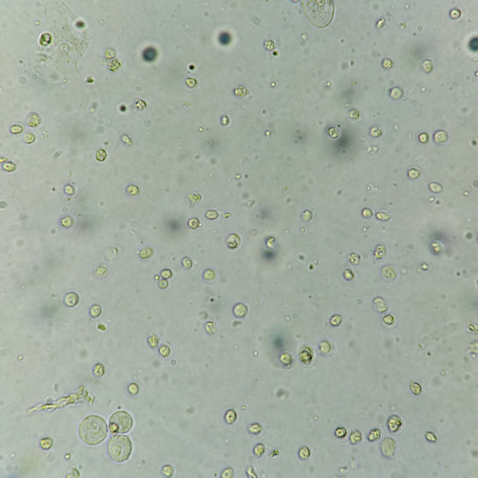 WBCs in Urine: Identification & Significance - MedLabBuddy