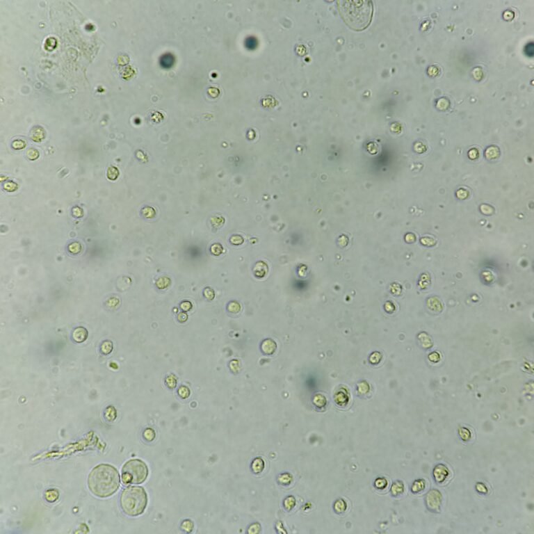 WBCs in Urine: Identification & Significance - MedLabBuddy