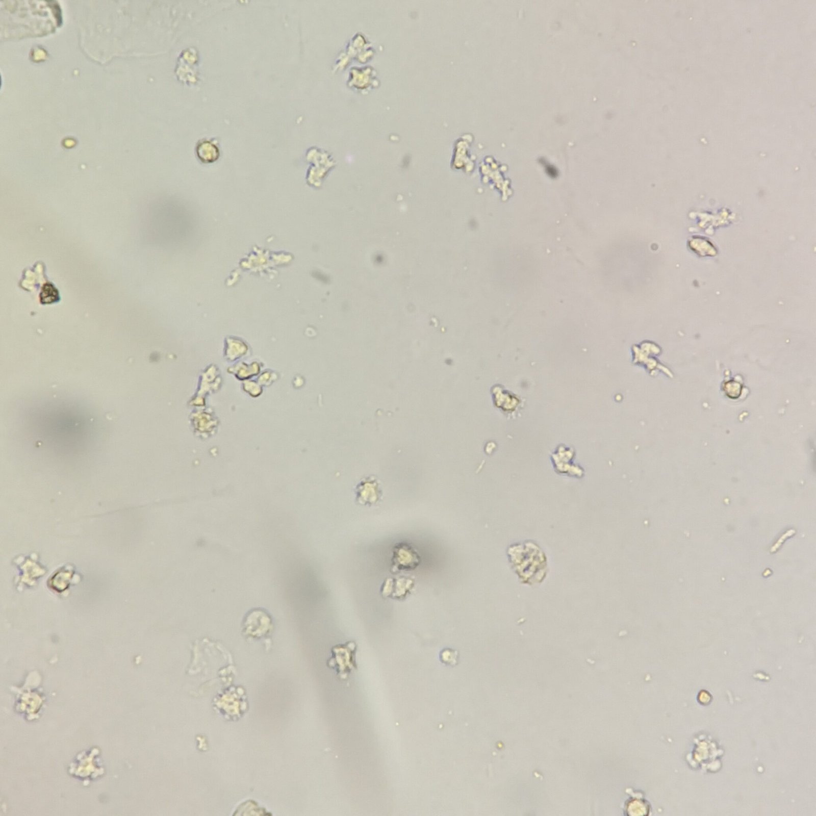 WBCs in Urine: Identification & Significance - MedLabBuddy