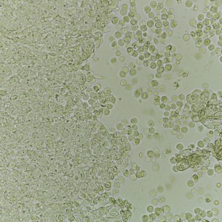 WBCs in Urine: Identification & Significance - MedLabBuddy