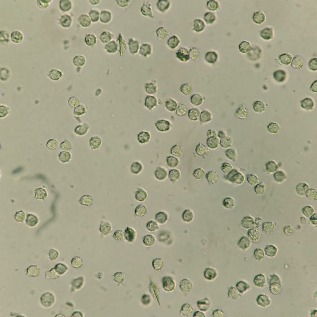 Body Fluid Crystals: Identification and Clinical Significance