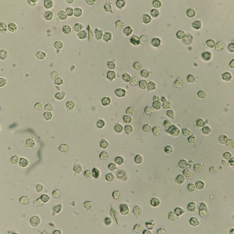 Body Fluid Crystals: Identification and Clinical Significance