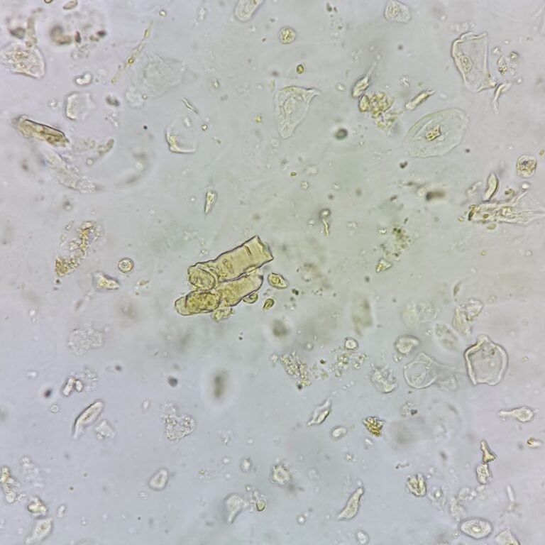 White Blood Cell Casts: Identification & Significance - MedLabBuddy