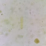 Waxy Casts: Identification & Significance - MedLabBuddy