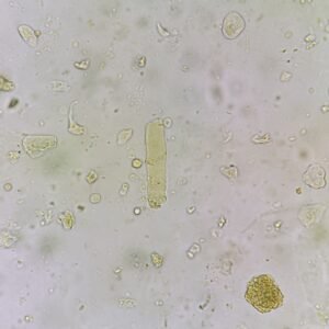 Waxy Casts: Identification & Significance - MedLabBuddy