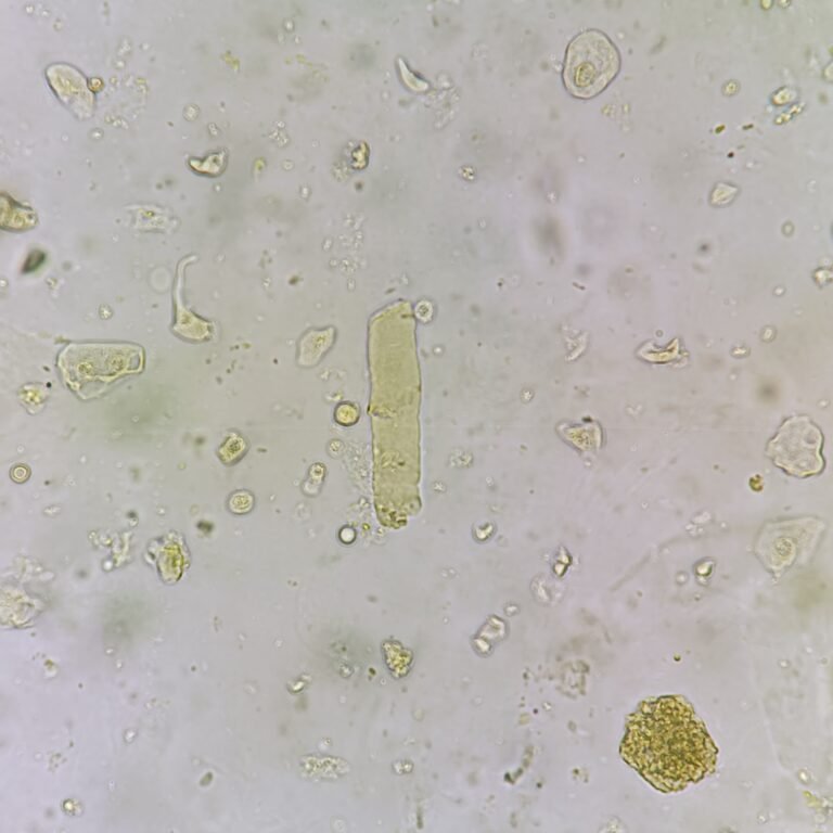 Urinary Casts: Identification & Significance